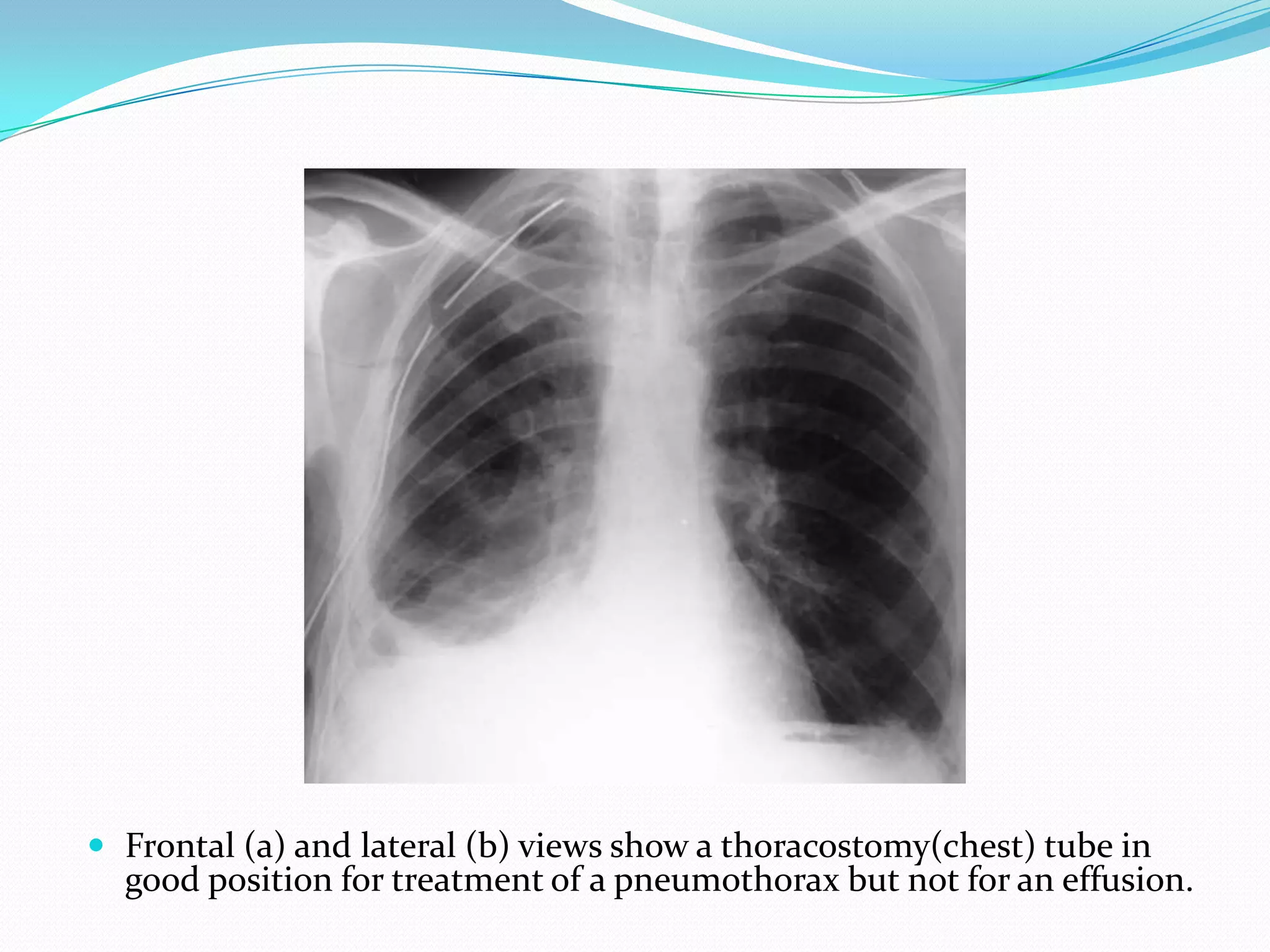 Medical devices on the chest x ray | PPTX