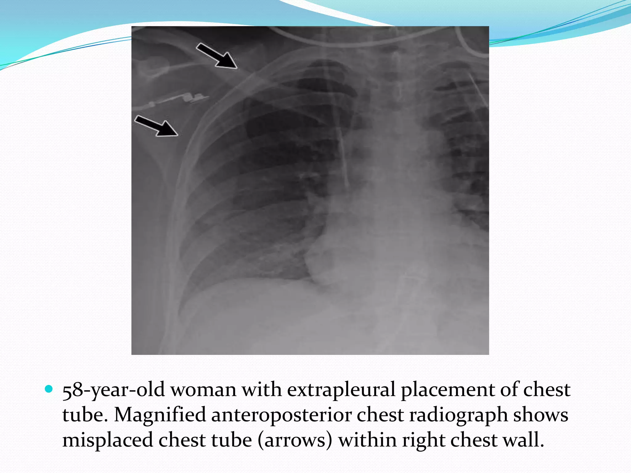 Medical devices on the chest x ray | PPTX