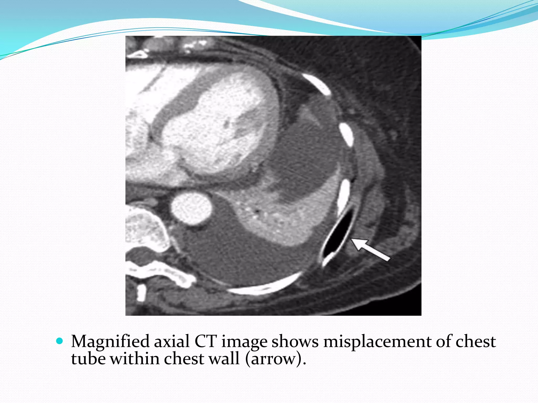 Medical devices on the chest x ray | PPTX