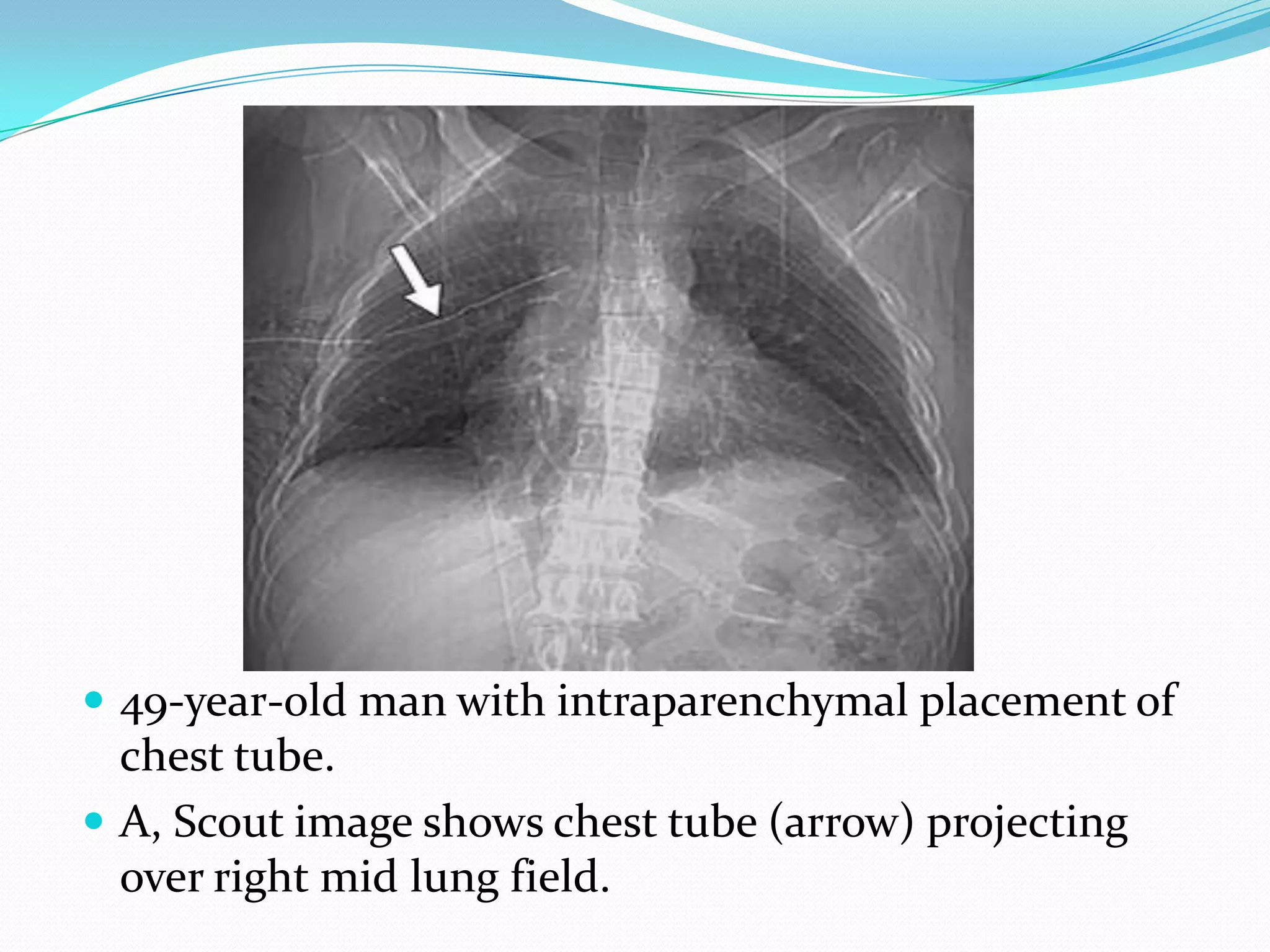 Medical devices on the chest x ray | PPTX