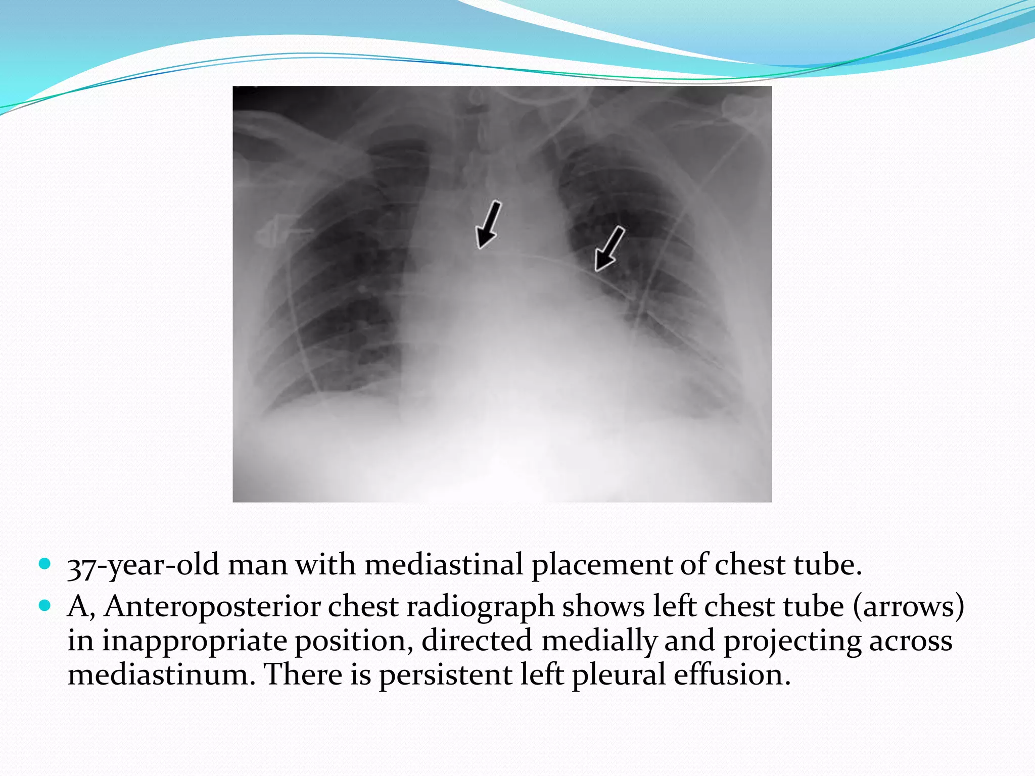 Medical devices on the chest x ray | PPTX