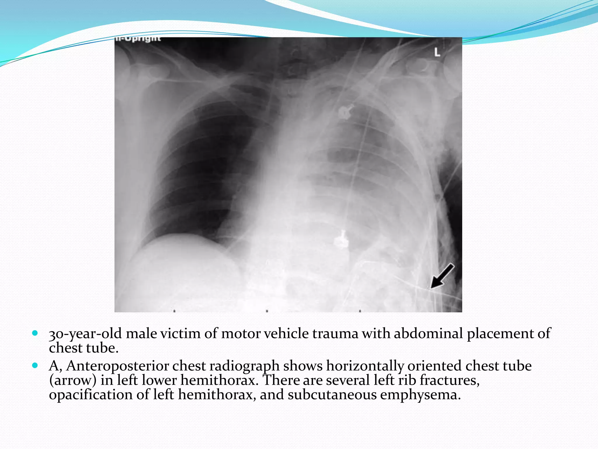 Medical devices on the chest x ray | PPTX