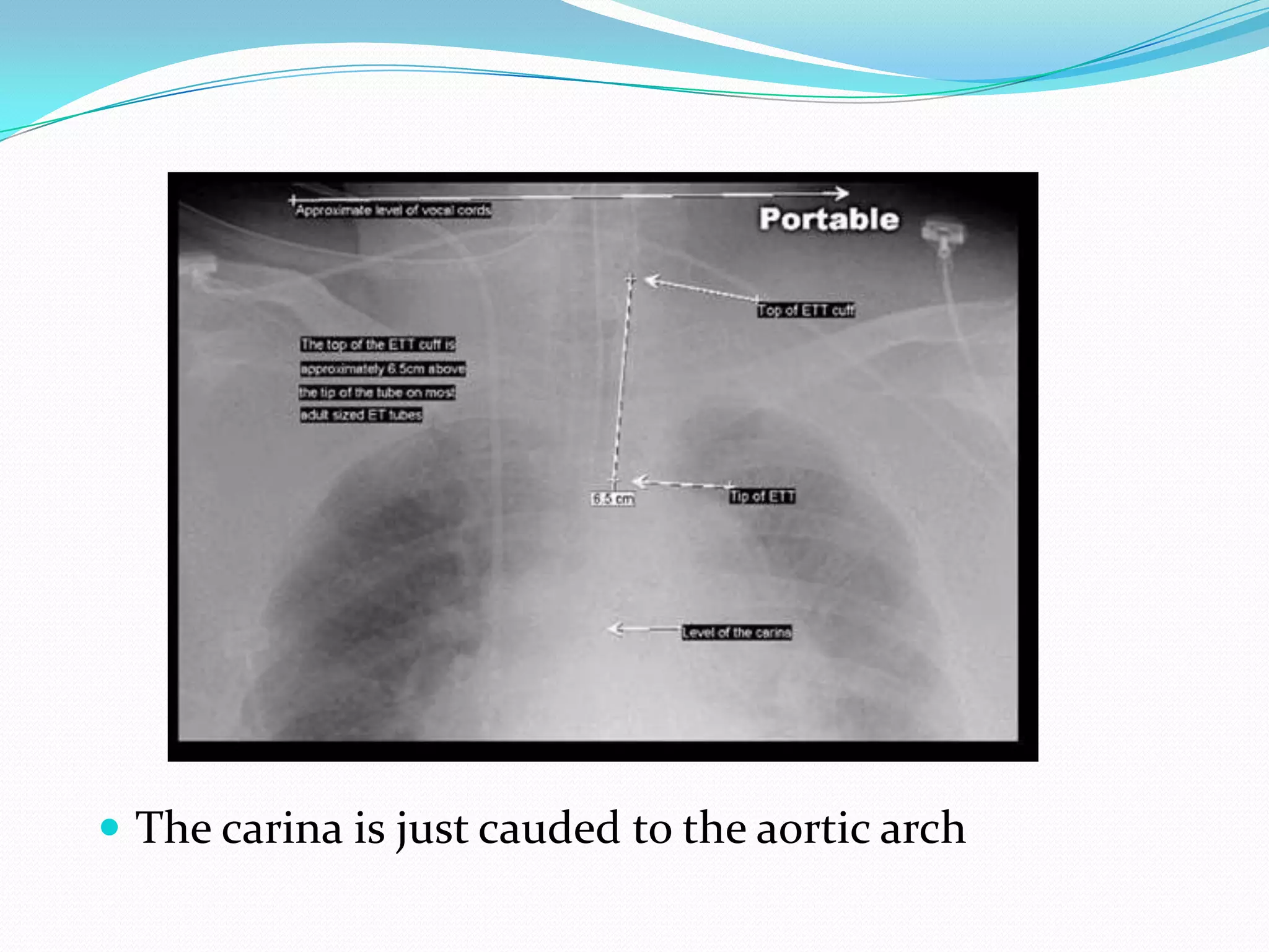 Medical devices on the chest x ray | PPTX