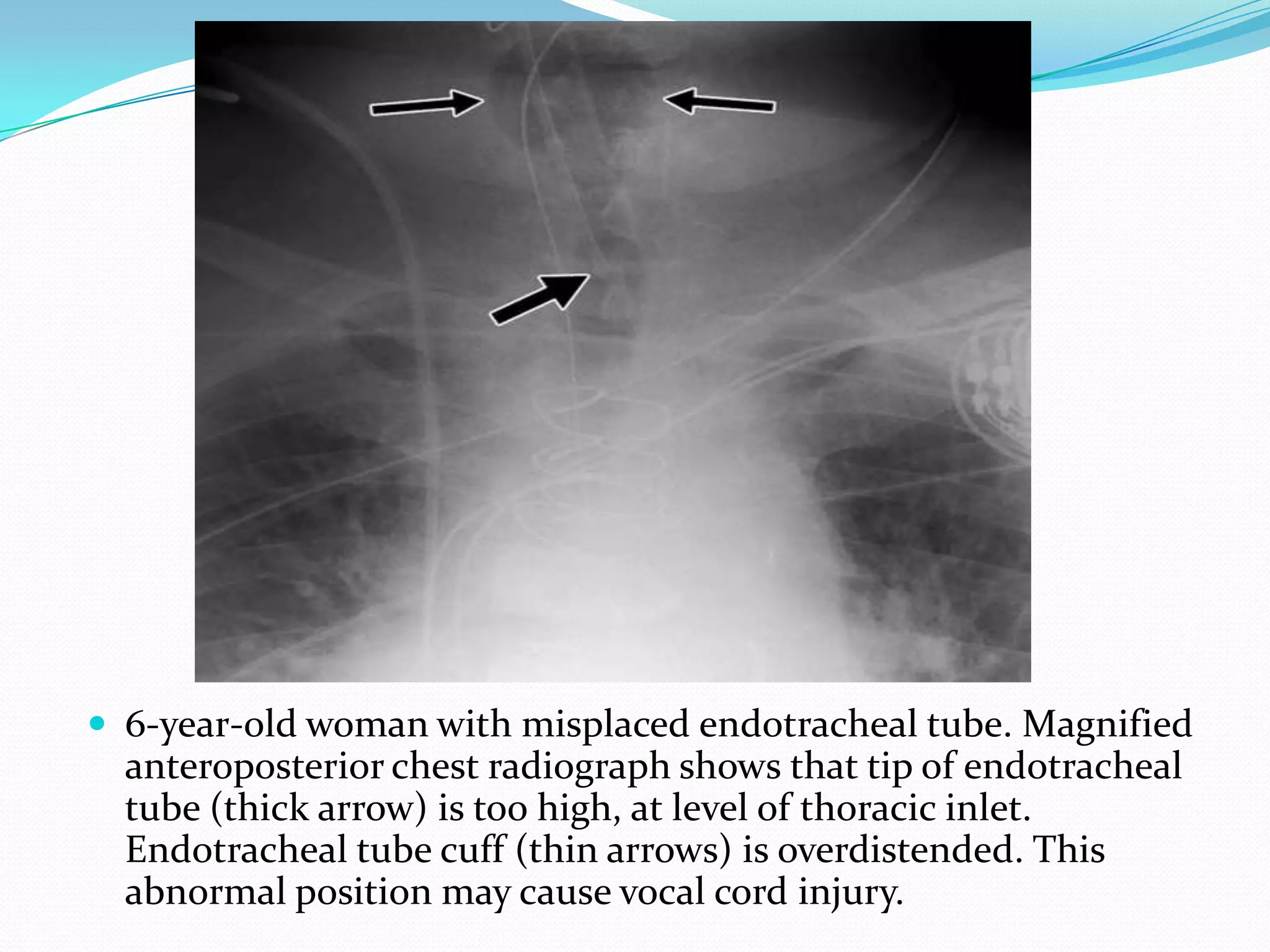 Medical devices on the chest x ray | PPTX