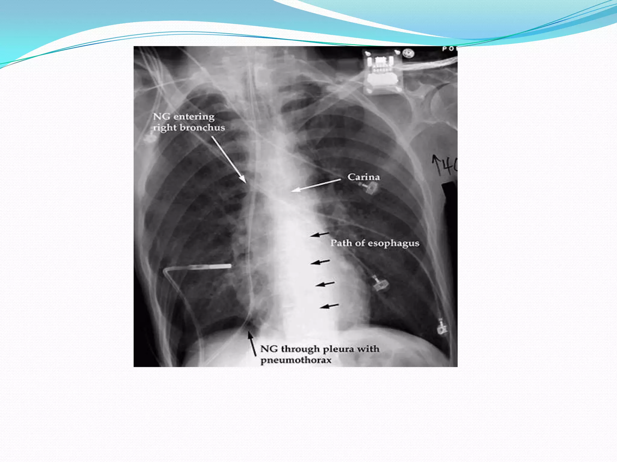 Medical devices on the chest x ray | PPTX