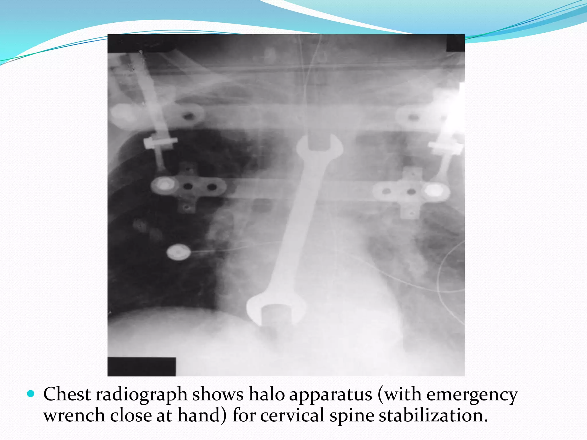 Medical devices on the chest x ray | PPTX