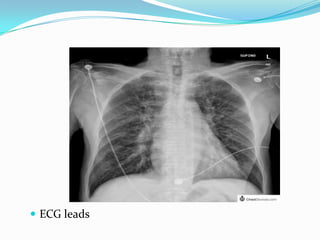 Medical devices on the chest x ray | PPTX