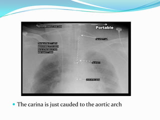 Medical devices on the chest x ray | PPTX