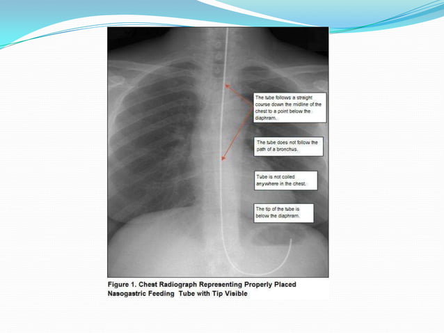 Medical devices on the chest x ray | PPTX