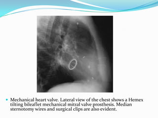Medical devices on the chest x ray | PPTX