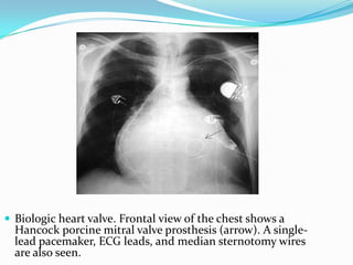 Medical devices on the chest x ray | PPTX