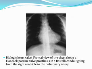 Medical devices on the chest x ray | PPTX