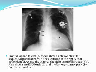 Medical devices on the chest x ray | PPTX