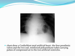 Medical devices on the chest x ray | PPTX