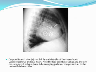 Medical devices on the chest x ray | PPTX