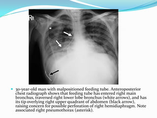 Medical devices on the chest x ray | PPTX
