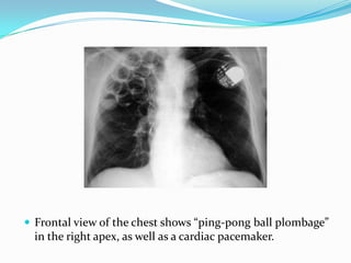 Medical devices on the chest x ray | PPTX