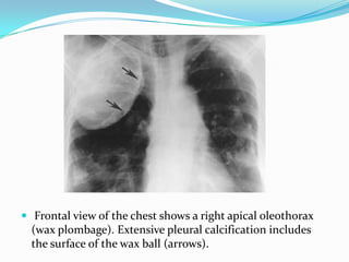 Medical devices on the chest x ray | PPTX