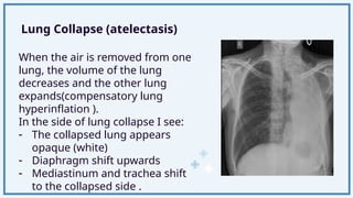 presentation about imaging of lung collapse | PPTX