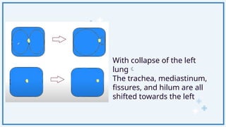 presentation about imaging of lung collapse | PPTX