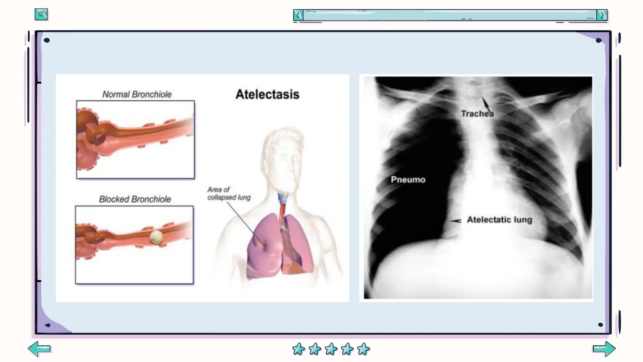 Medical Imaging Presentation - ATELECTASIS.pptx