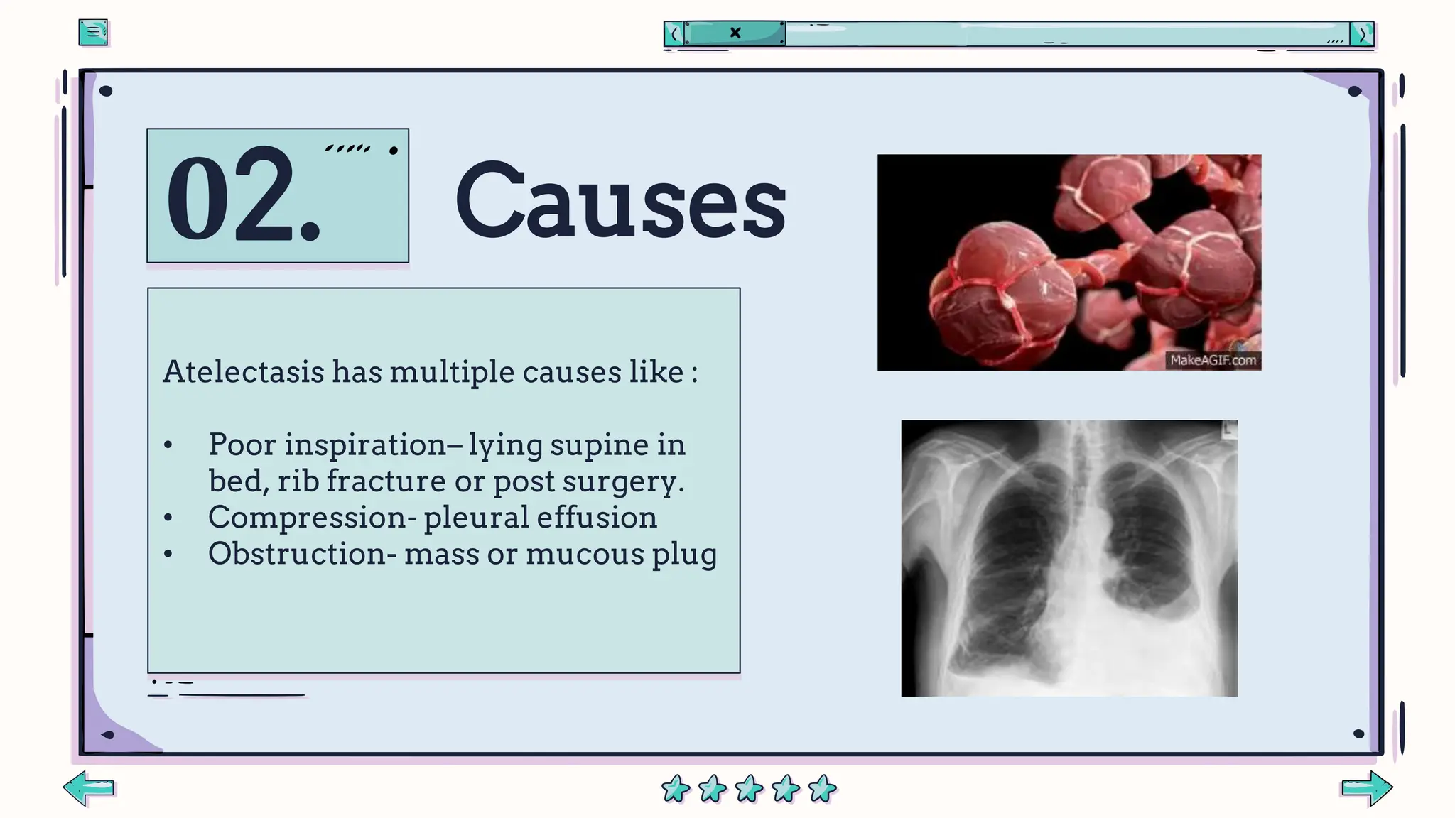 Medical Imaging Presentation - ATELECTASIS.pptx