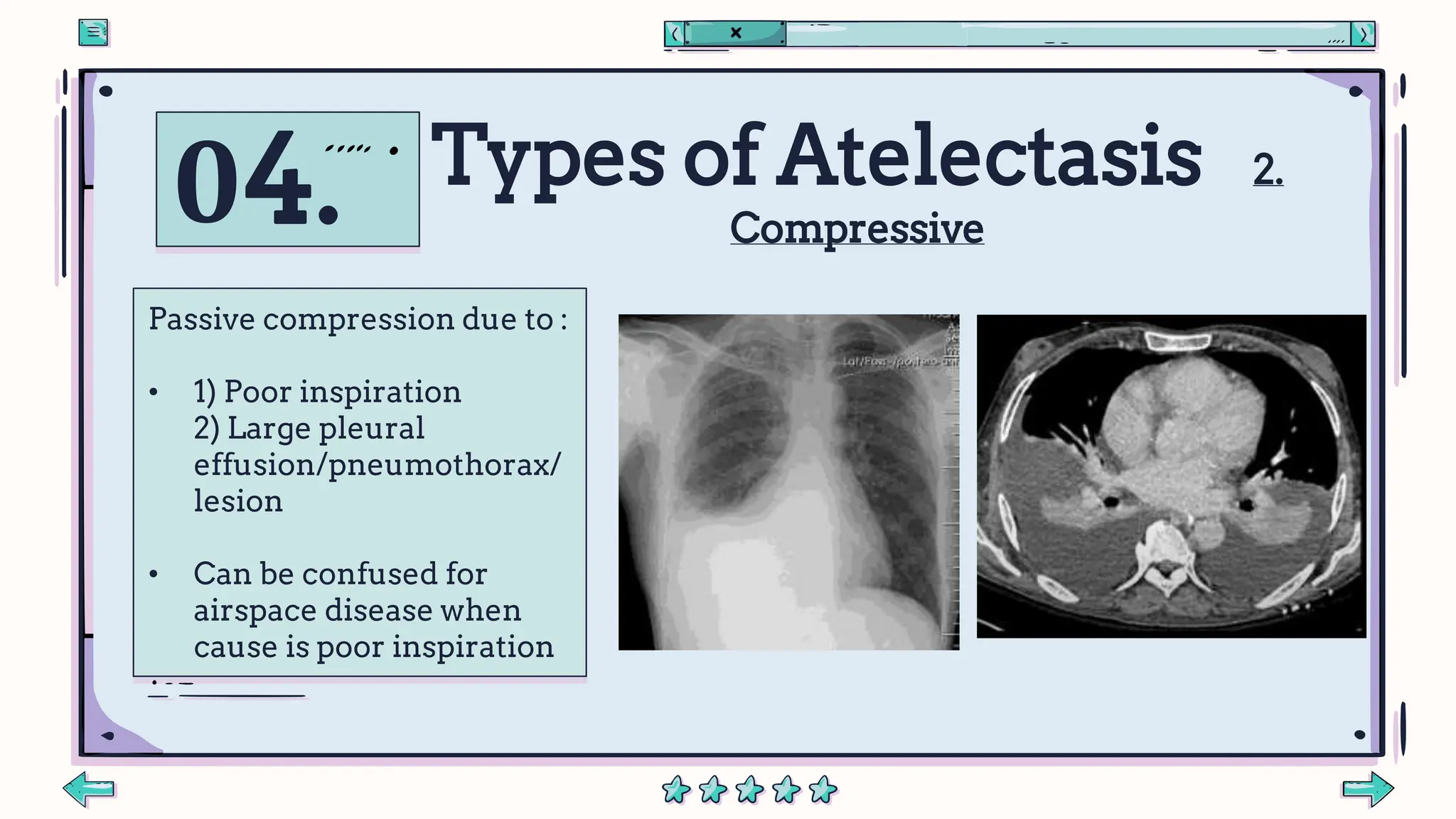 Medical Imaging Presentation - ATELECTASIS.pptx