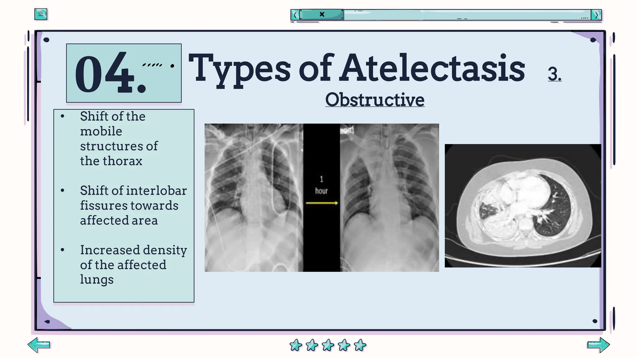Medical Imaging Presentation - ATELECTASIS.pptx