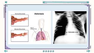 Medical Imaging Presentation - ATELECTASIS.pptx