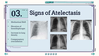 Medical Imaging Presentation - ATELECTASIS.pptx