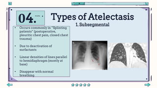 Medical Imaging Presentation - ATELECTASIS.pptx