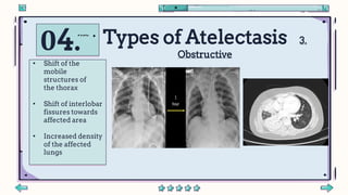 Medical Imaging Presentation - ATELECTASIS.pptx