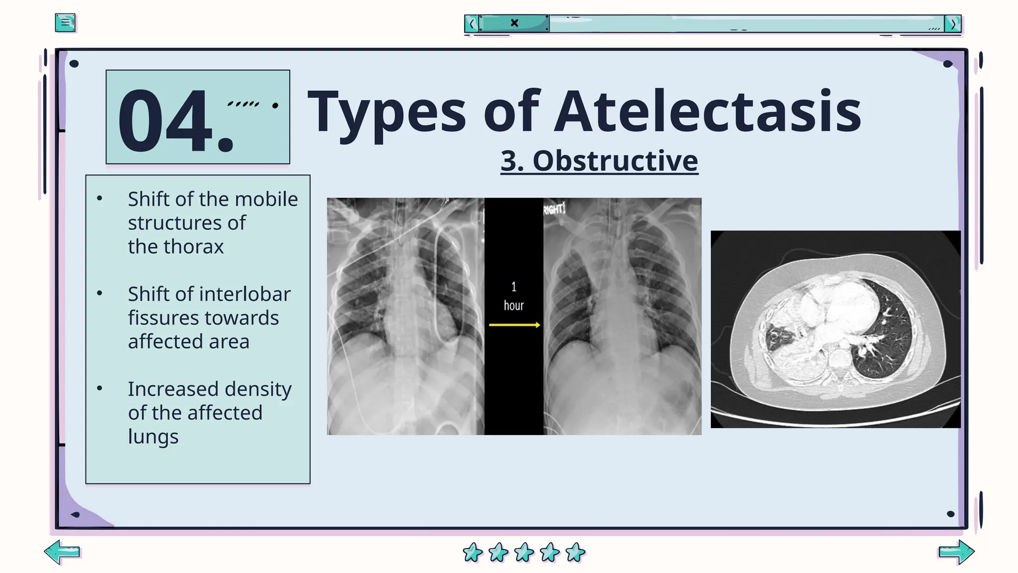 Medical Imaging Presentation - ATELECTASIS.pptx