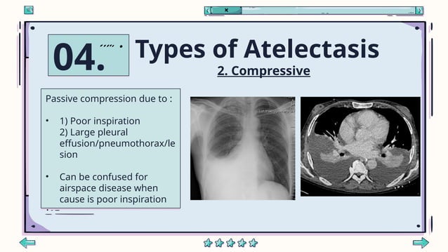 Medical Imaging Presentation - ATELECTASIS.pptx