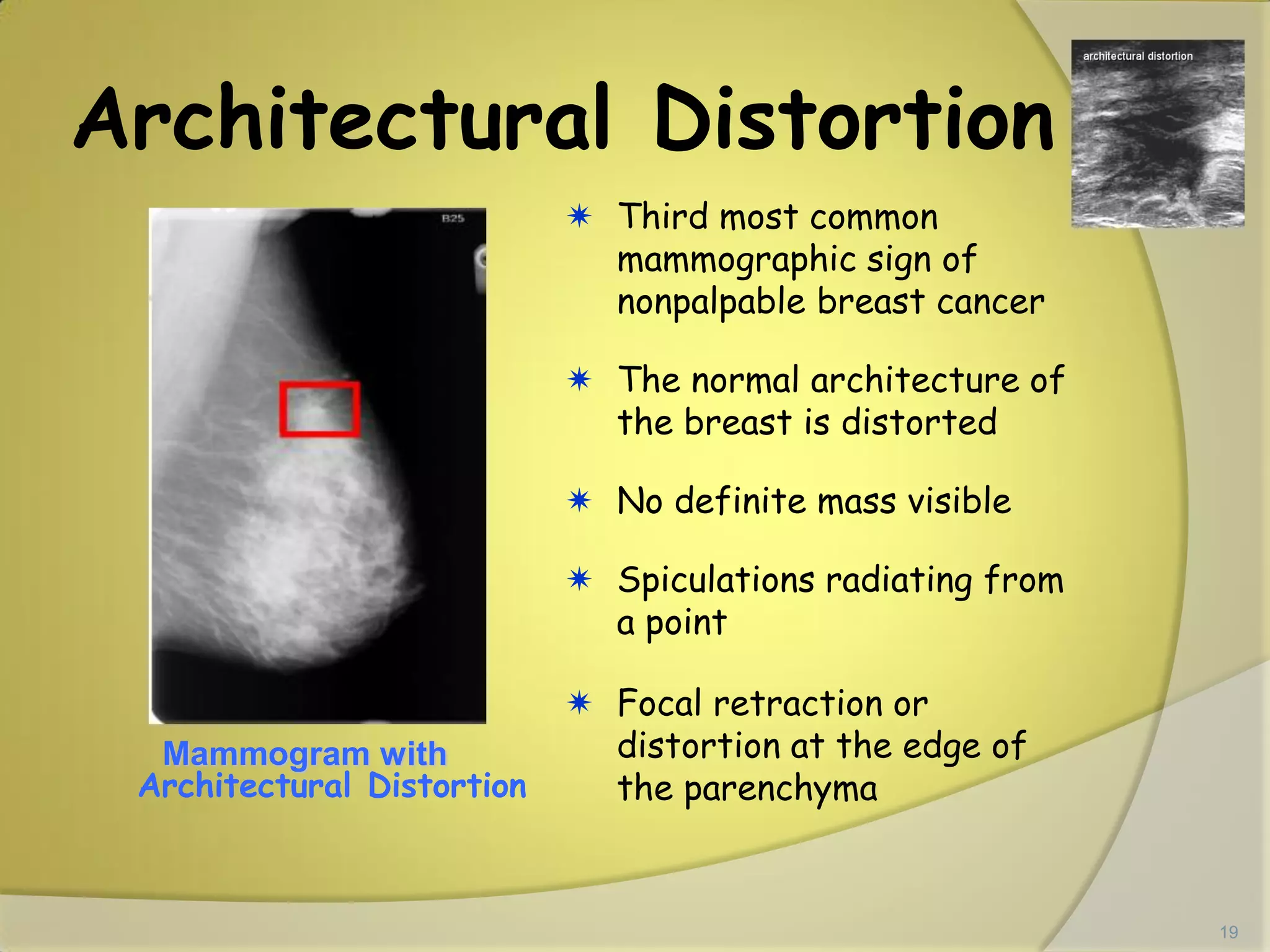 Breast Cancer - A Study (Early Detection) | PDF