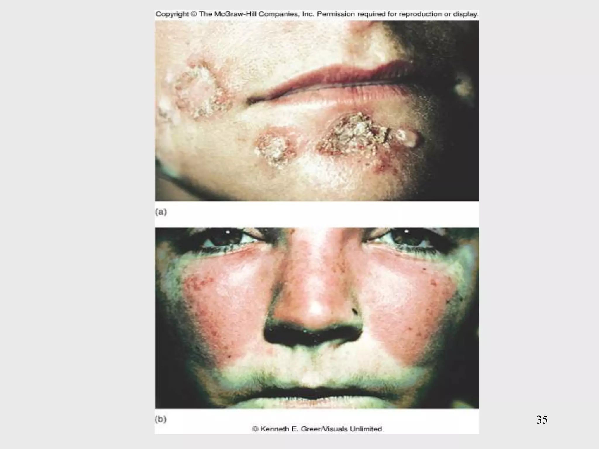 Medical Important G+ cocci.ppt | Infectious Diseases | Diseases and ...