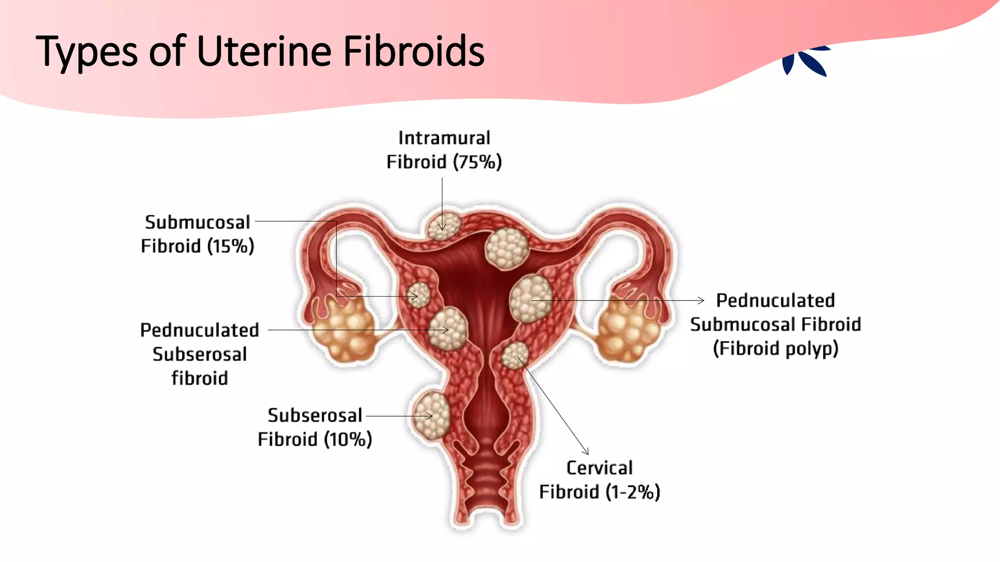Medical Management of Fibroids | PPTX