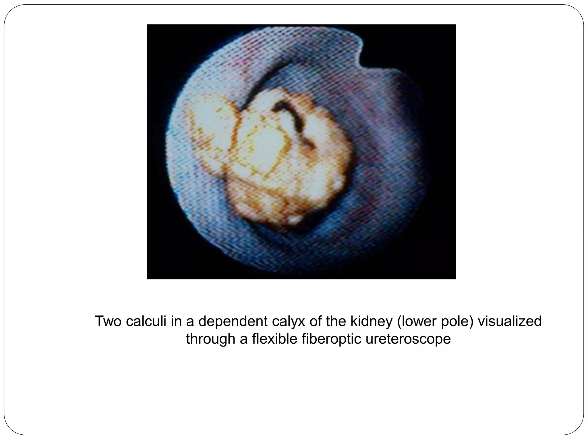 Medical management of renal stones | PPTX