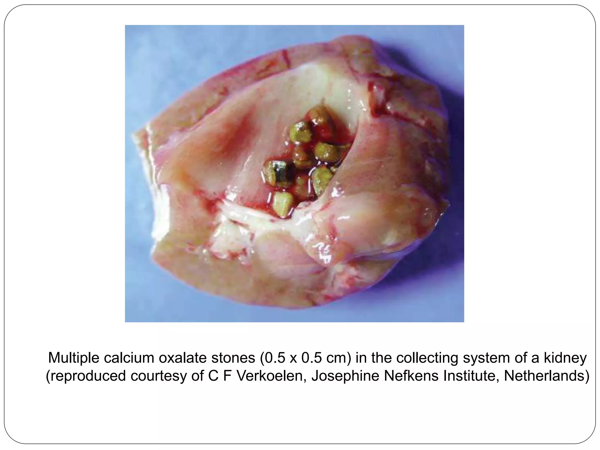 Medical management of renal stones | PPTX