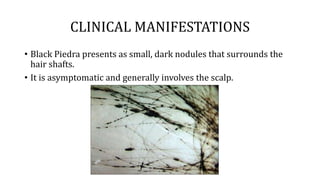 Medical Mycology Black Piedra and White Piedra.pptx