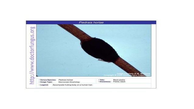 Medical Mycology Black Piedra and White Piedra.pptx | Skin and ...