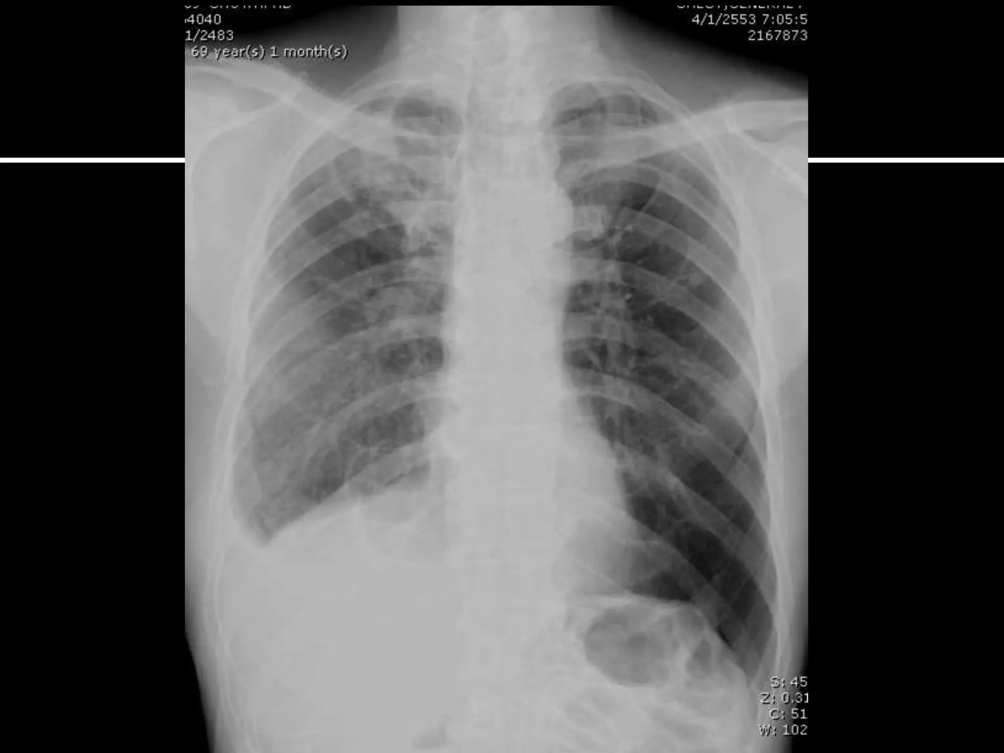 Medical pleurodesis | PPTX