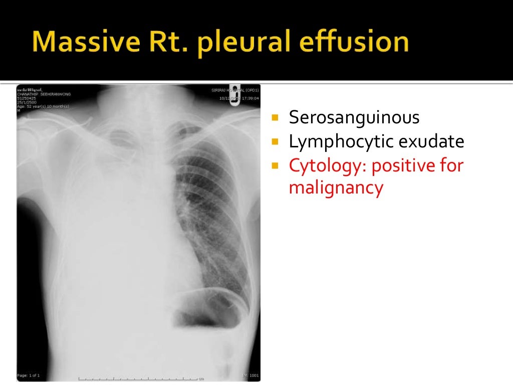 Medical pleurodesis