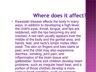 Medical research kawasaki disease | ODP