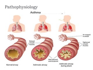 Medical surgical Nursing (asthma), | PPTX