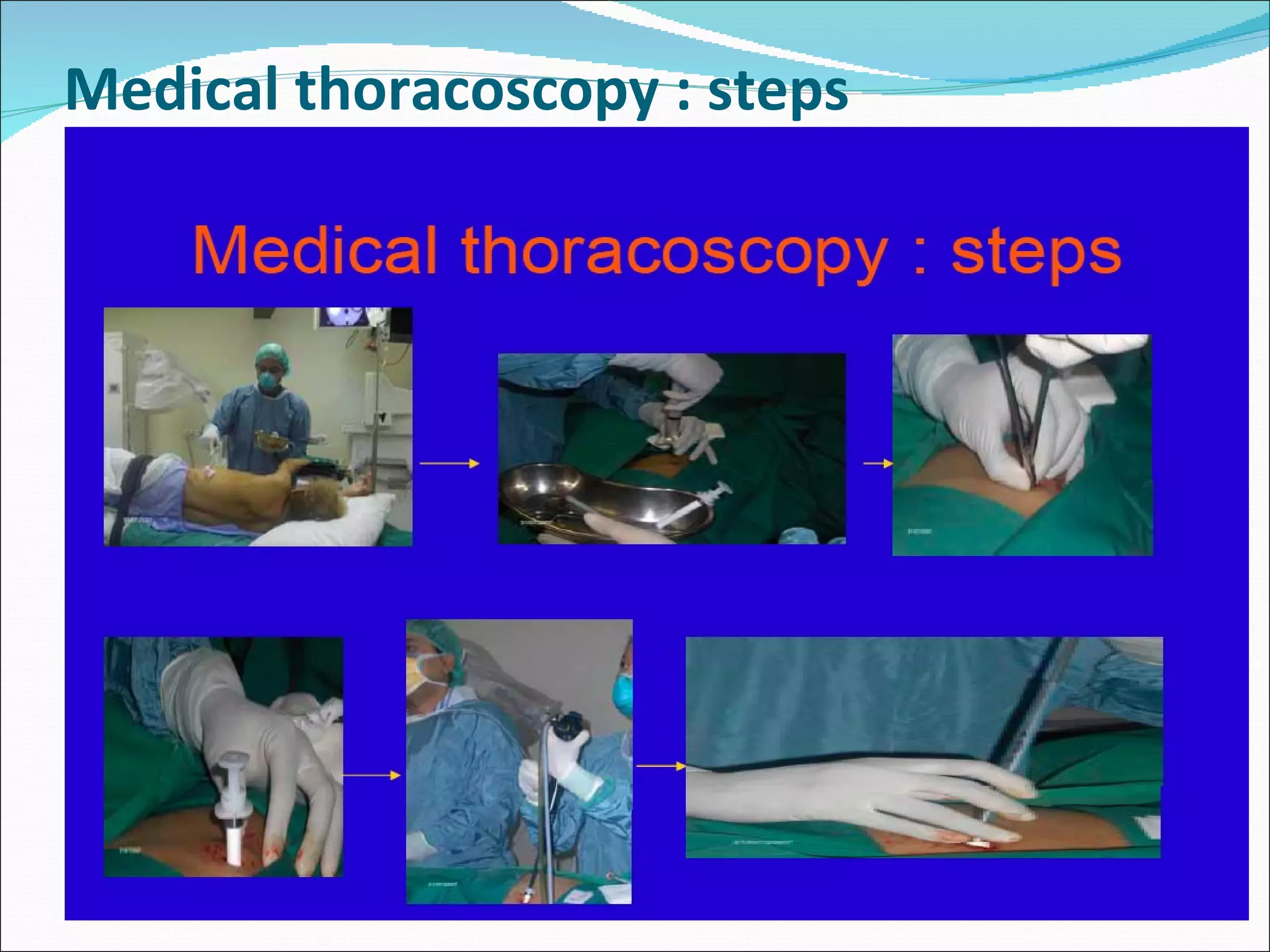 Medical Thoracoscopy | PPT