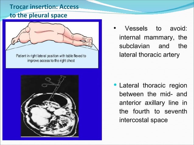 Medical Thoracoscopy | PPT | Lung and Respiratory Health | Diseases and ...