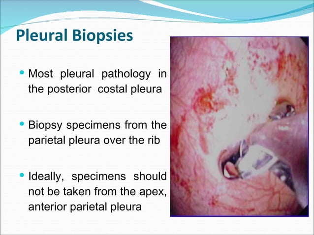 Medical Thoracoscopy | PPT | Lung and Respiratory Health | Diseases and ...