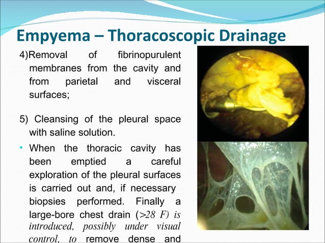 Medical Thoracoscopy | PPT | Lung and Respiratory Health | Diseases and ...