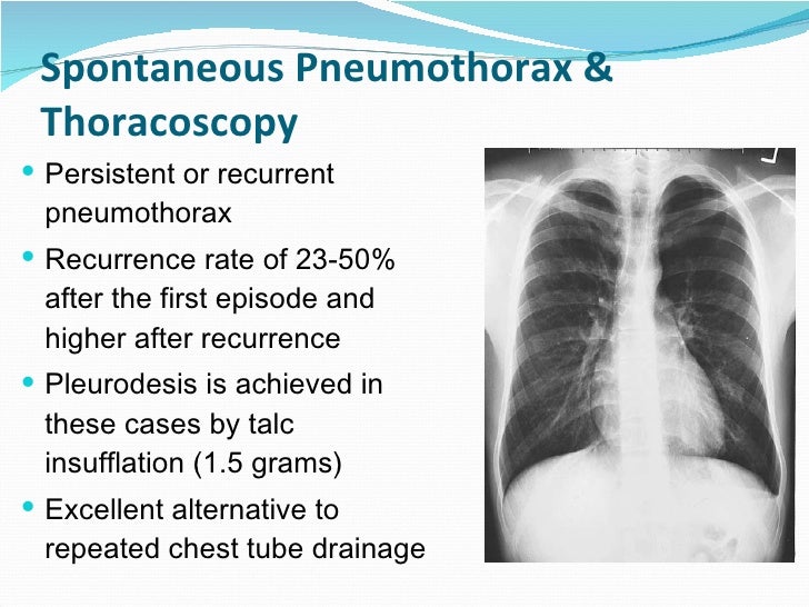 Medical Thoracoscopy